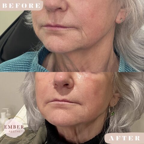 Dermal Filler - Ember Aesthetics